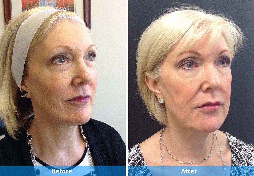 What is Sculptra? | Dermacare Medical Spa